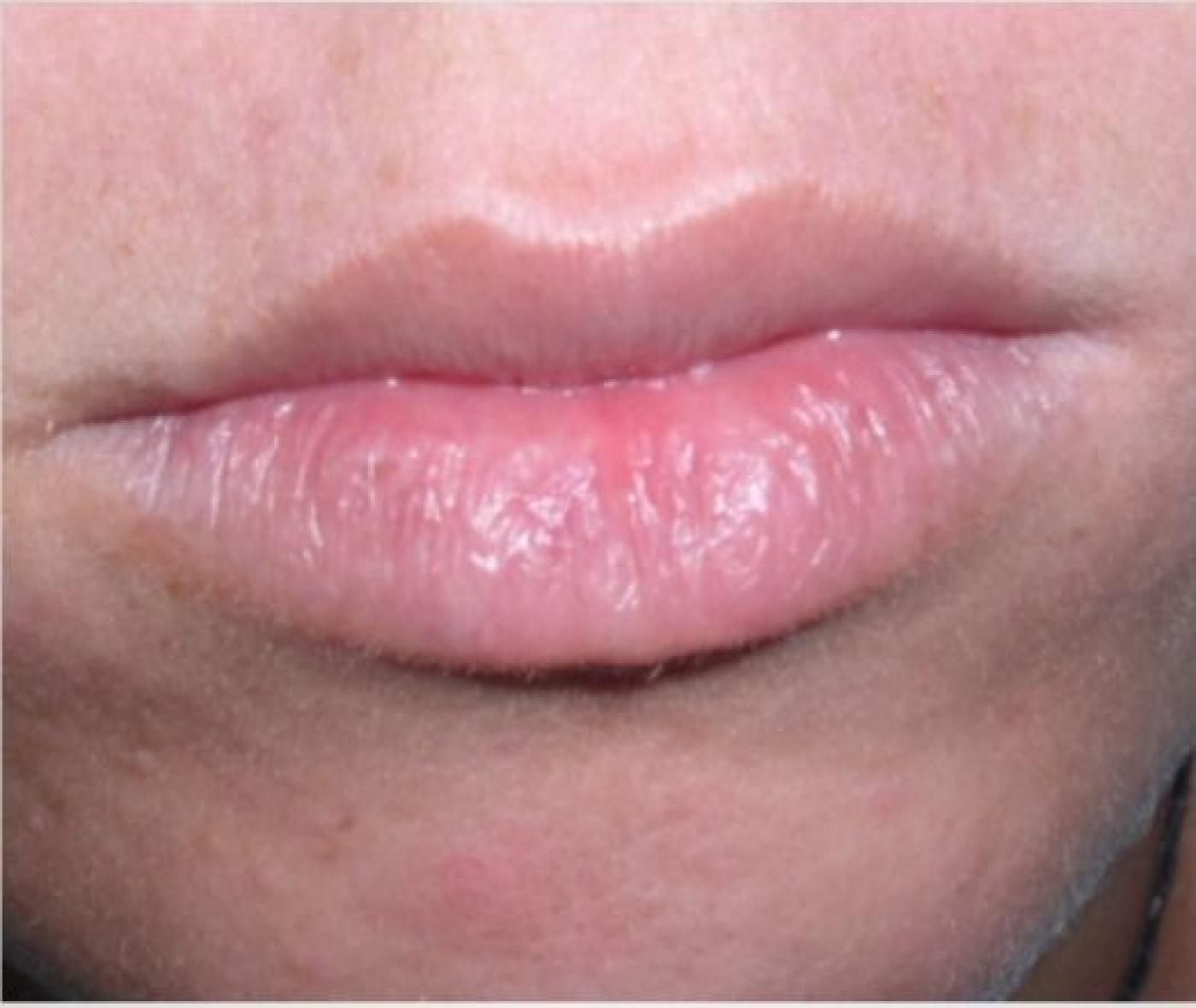 Ação na praia em Santos neste sábado busca identificar câncer labial ...